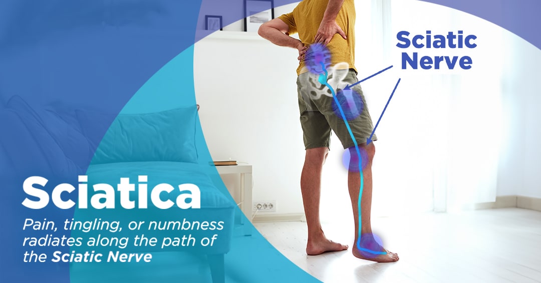 Physical Therapy Exercises for Sciatica - Confluent Health